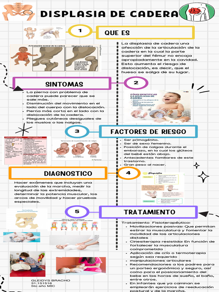 Gleidys Displasia de Cadera | PDF | Nalgas | Sistema musculoesquelético