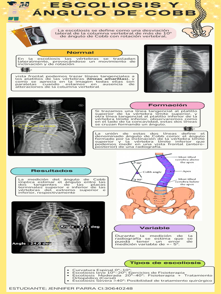 Infografia Escoliosis Jennifer | PDF | Escoliosis