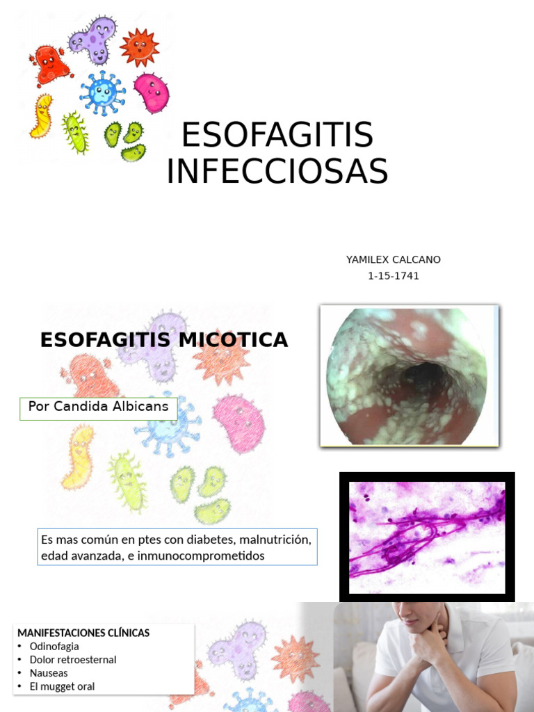 Esofagitis Infecciosa: Diagnóstico y Tratamiento | PDF | Cáncer de ...