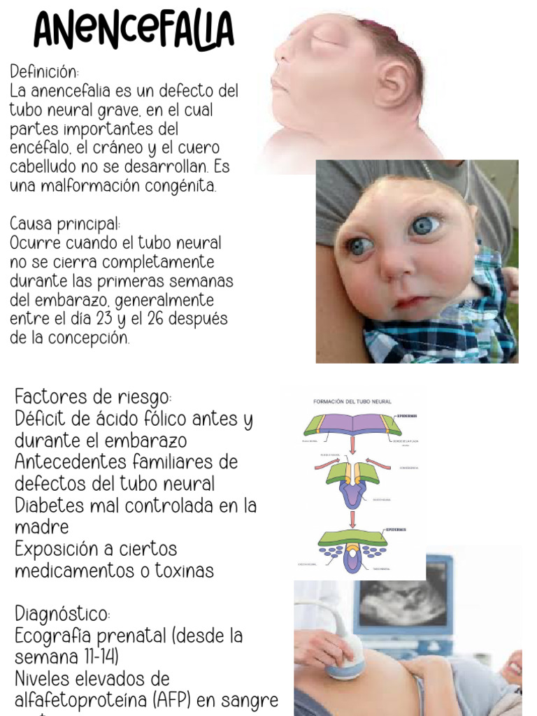 Anencefalia y Epilepsia: Definiciones y Tratamientos | PDF