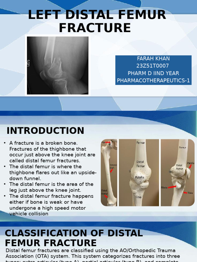 Left Distal Femur Fracture | PDF | Knee | Medical Specialties