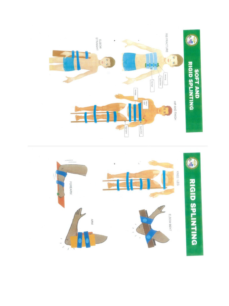 Rigid and Soft Splinting | PDF
