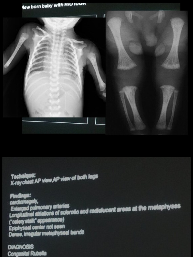 Congenital Syphilis and Rickets Findings | PDF | Osteoarthritis | Joint