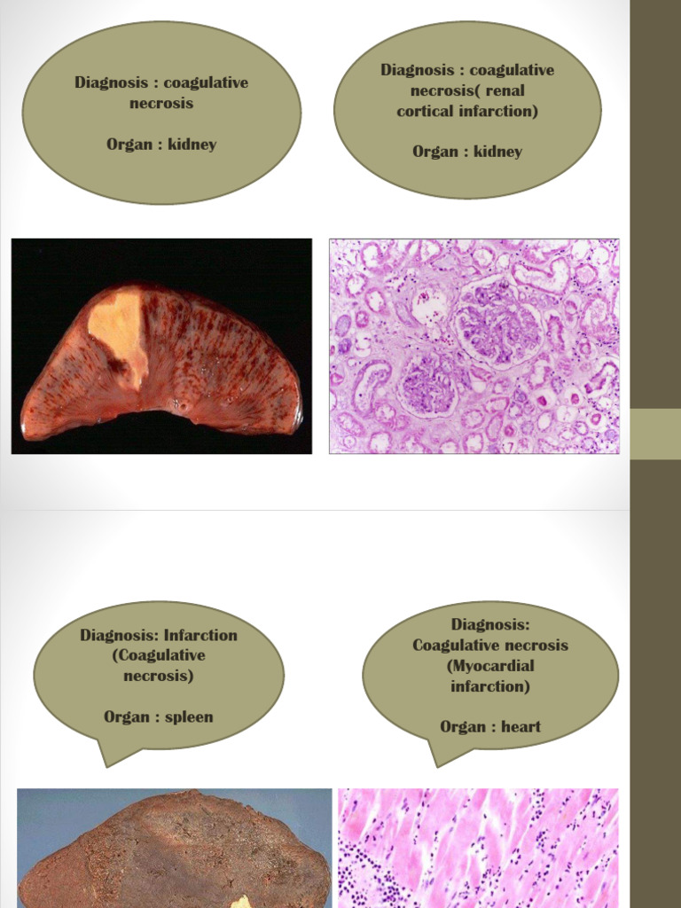 Patho. Slides 2 | PDF | Pancreas | Medical Specialties