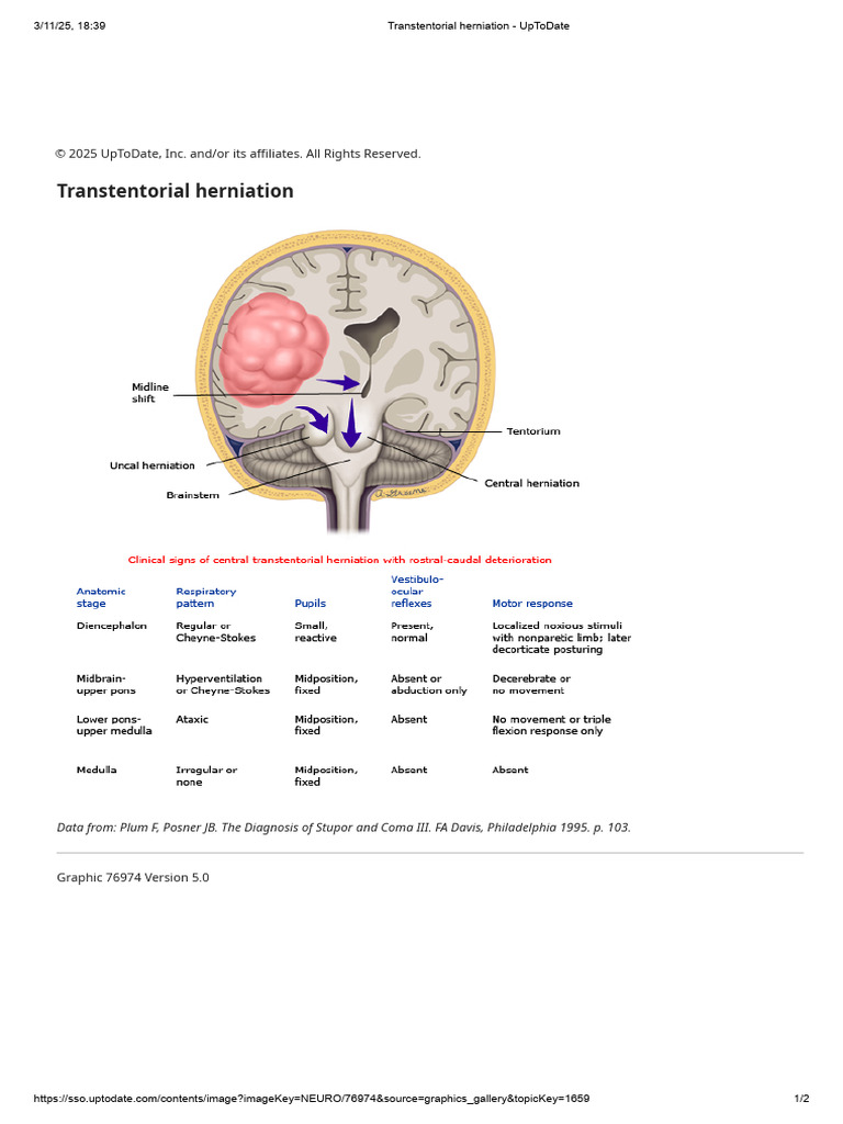 Transtentorial Herniation - UpToDate | PDF