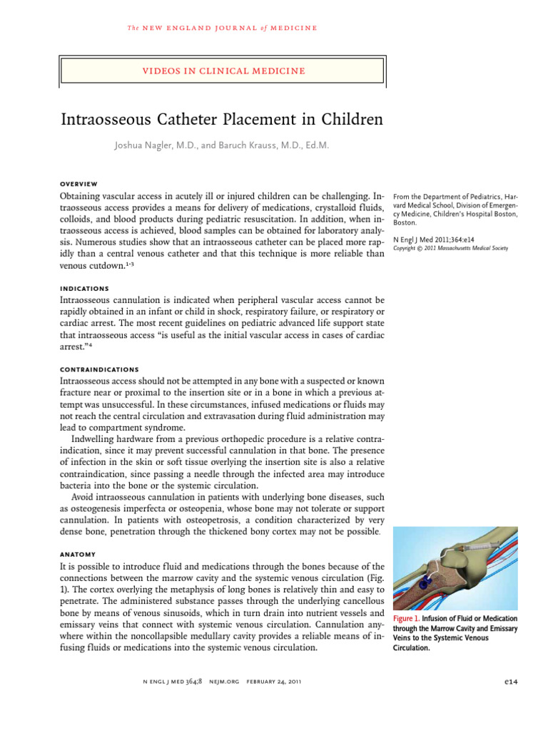 NEJM Intraosseous Catheter Placement in Children | PDF | Intravenous ...