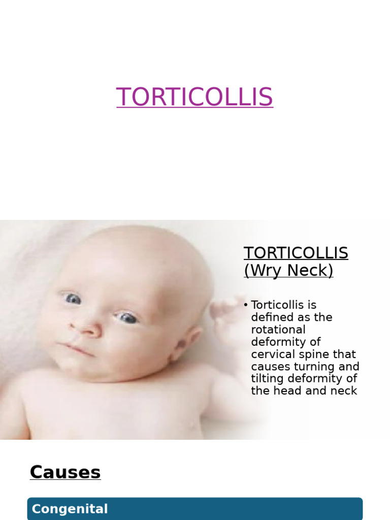 Torticollis | PDF | Human Diseases And Disorders | Musculoskeletal System
