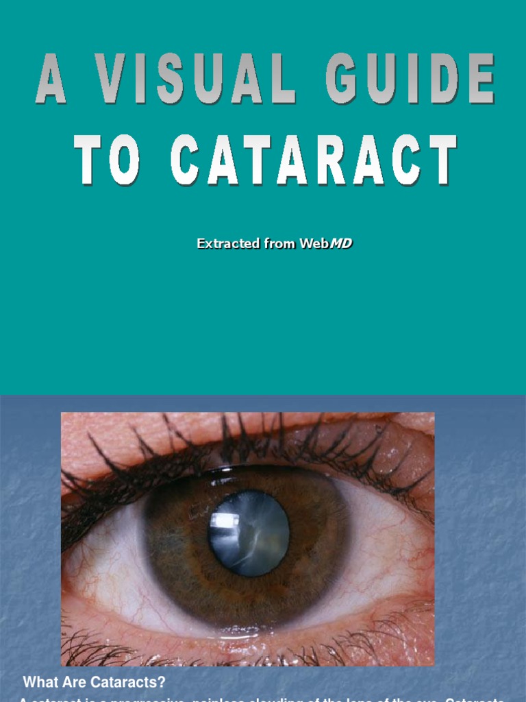 Visual Guide To Cataract | PDF | Ophthalmology | Optics