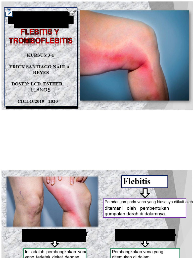 FLEBITIS | PDF