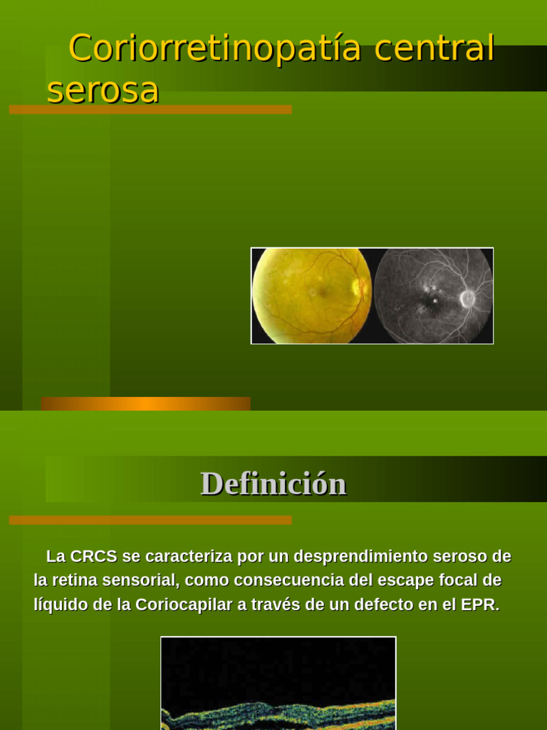 Coriorretinopatía Central Serosa: Causas y Tratamiento | PDF