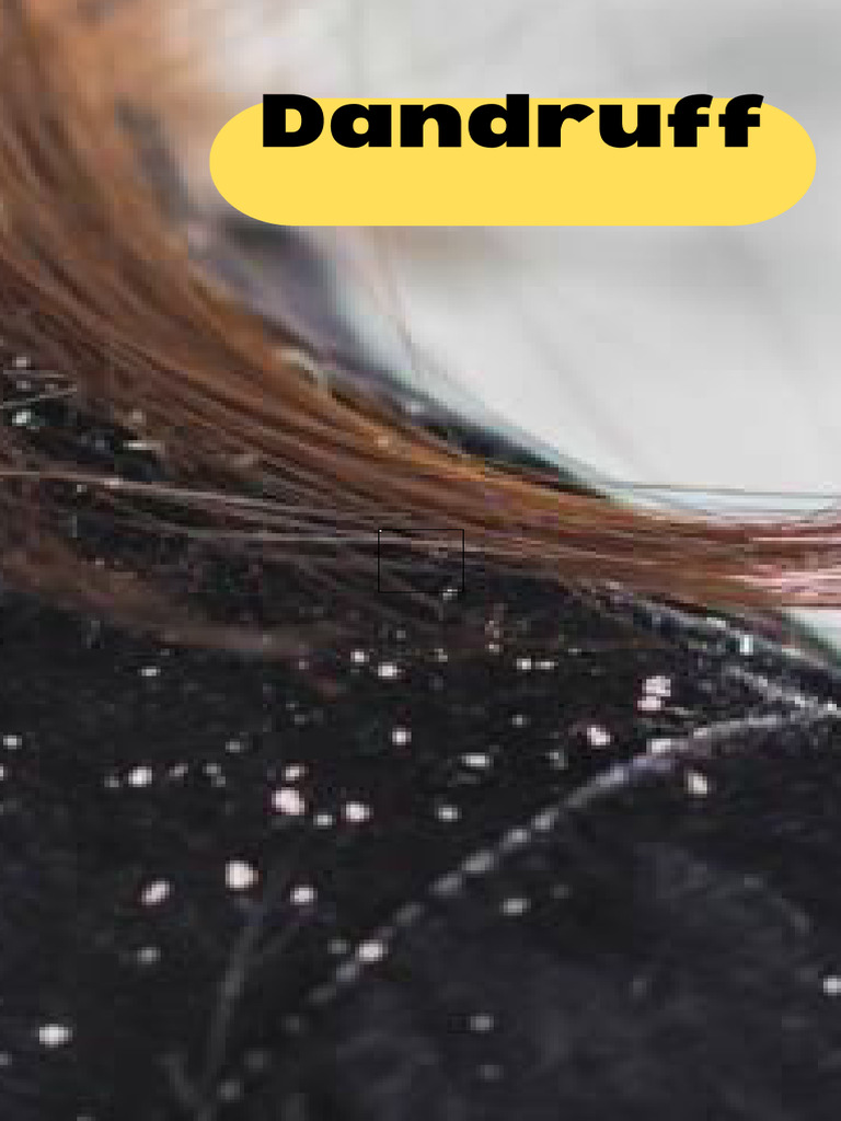 Understanding Dandruff Causes & Treatments | PDF