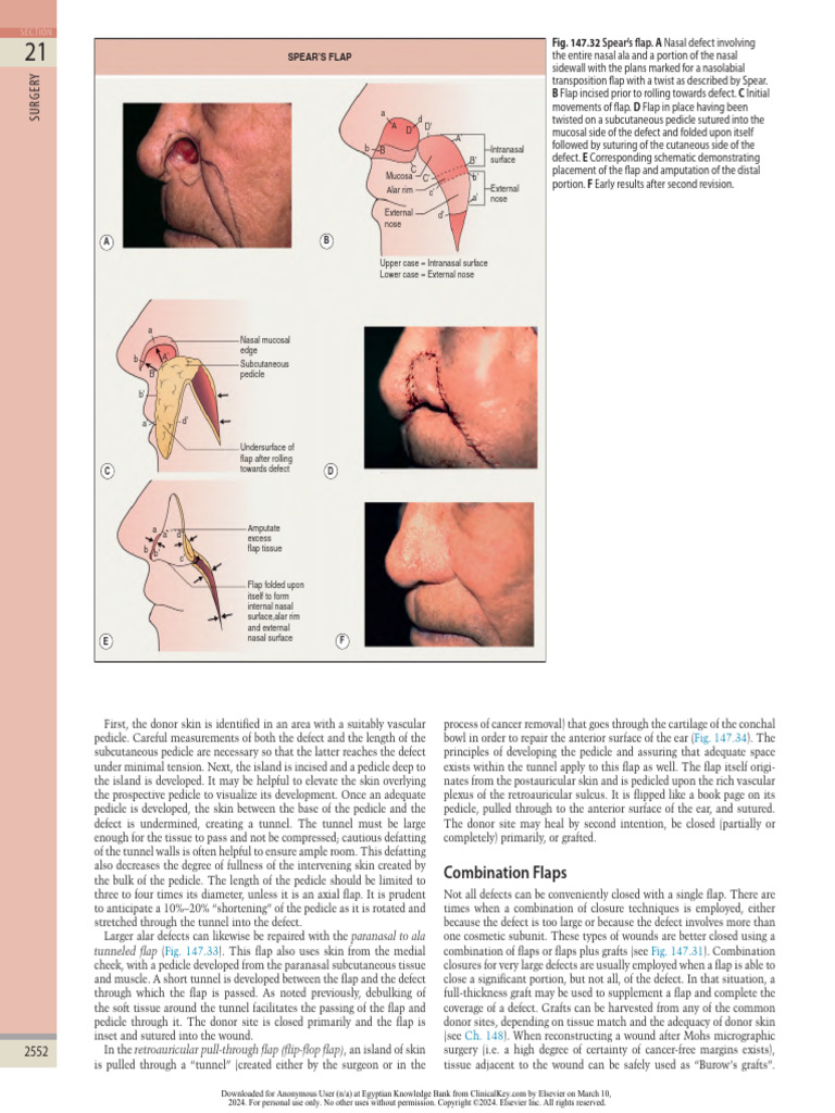 Cap151-Bolognia-Complicações Cirurgia | PDF | Human Nose | Wound