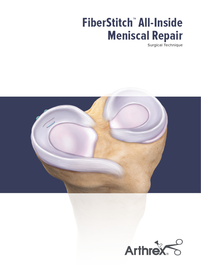 FiberStitch™ Meniscal Repair Technique | PDF | Surgical Suture ...