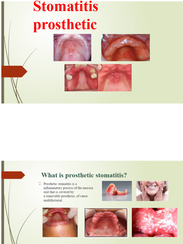 Prosthetic Stomatitis | PDF