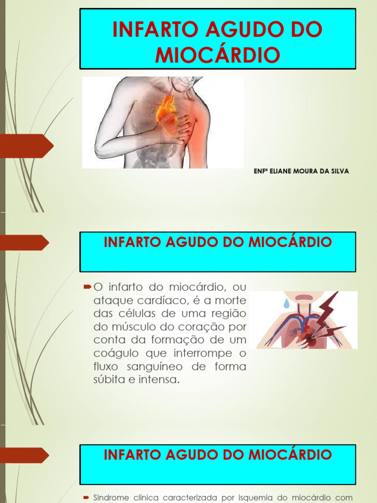 INFARTO AGUDO DO MIOCÁRDIO | PDF | Infarto do Miocárdio | Coração
