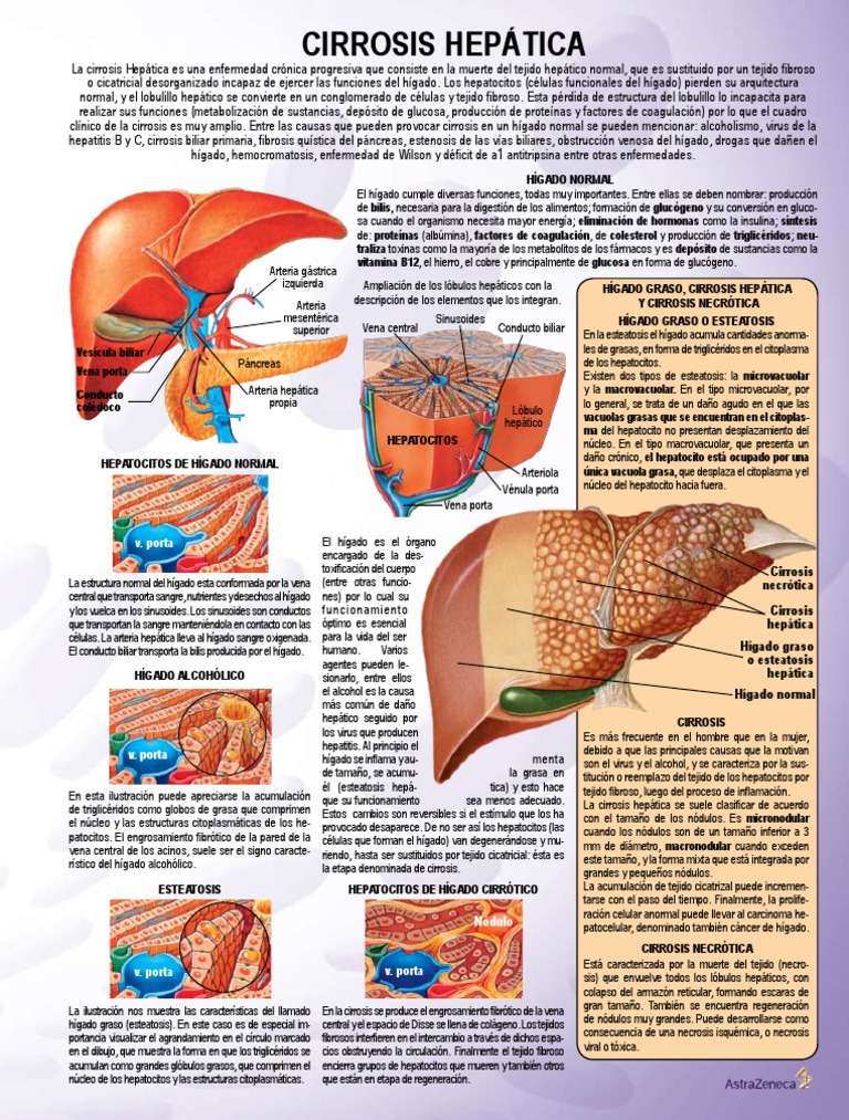 Cirrosishepatica Hígado Cirrosis