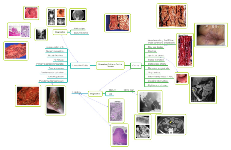 Ulcerative Colitis Vs Crohn's | PDF