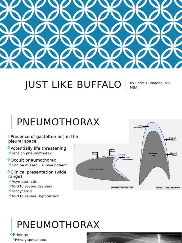 Simultaneous Bilateral Pnuemothoraces (Buffalo Pneumothorax) | PDF ...