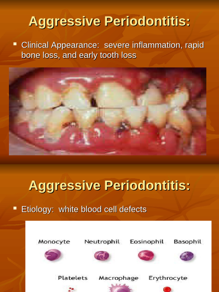 Aggressive Periodontitis Makhan | PDF