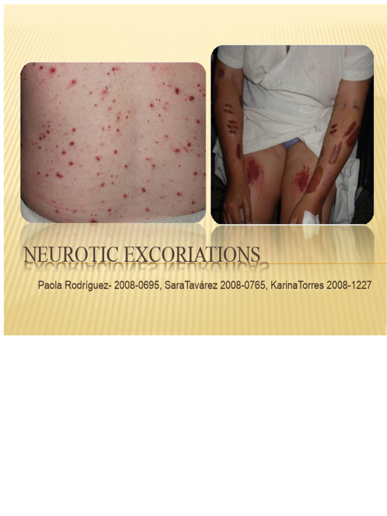 Neurotic excoriations | PDF | Diseases And Disorders | Medical Specialties