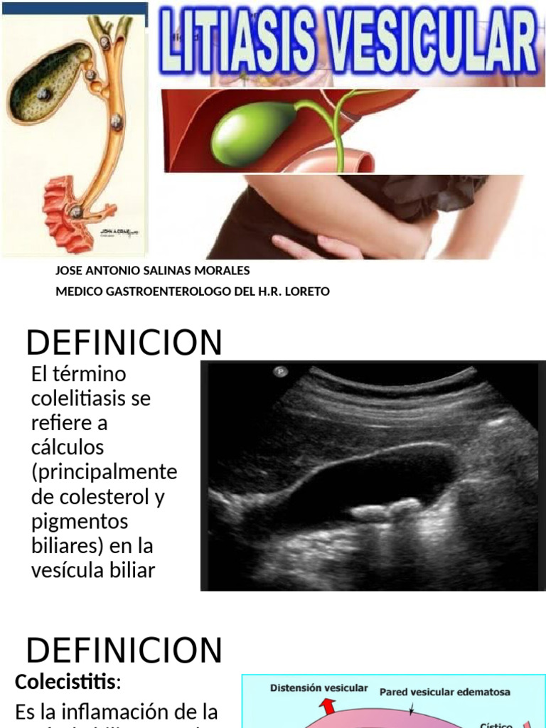 05 - Litiasis Vesicular | PDF | Enfermedades y trastornos humanos ...