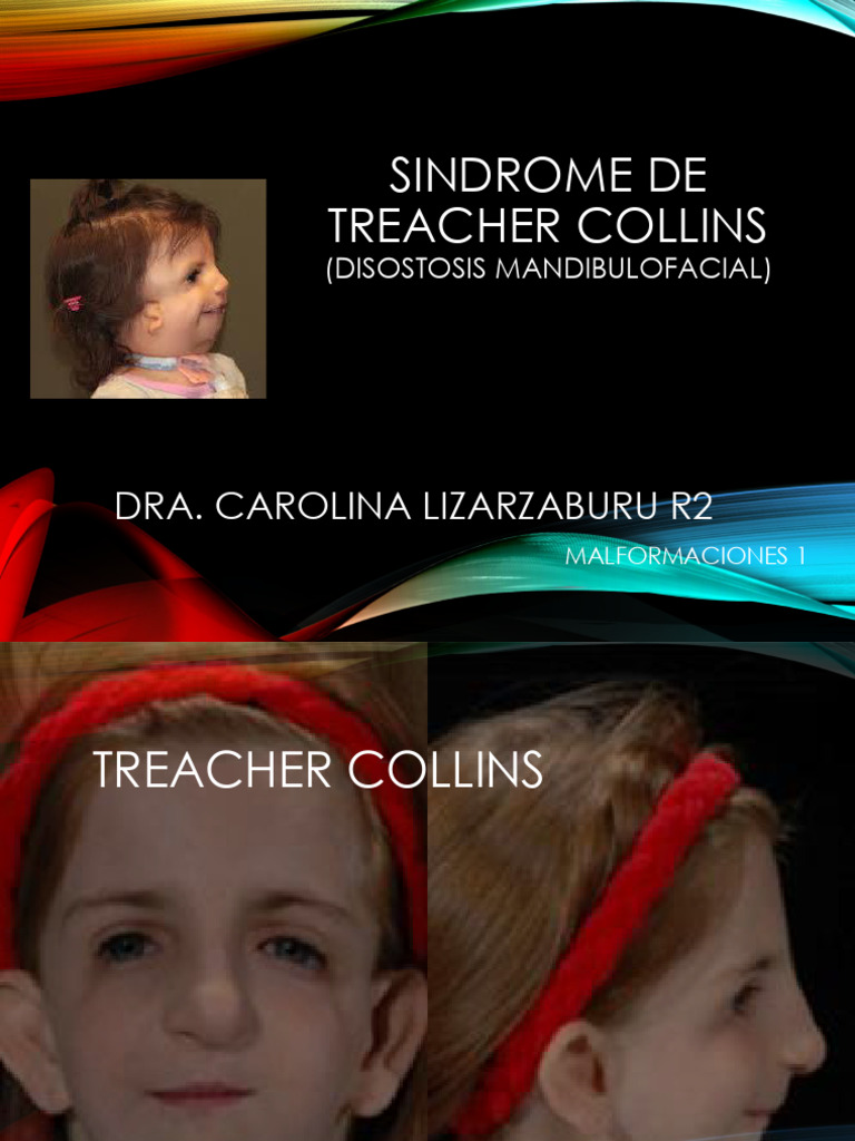 Síndrome de Treacher Collins: Malformaciones y Manejo | PDF | Síndrome ...