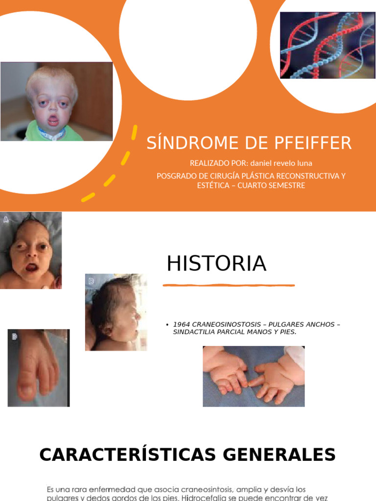 Características del Síndrome de Pfeiffer | PDF | Desorden congenito ...