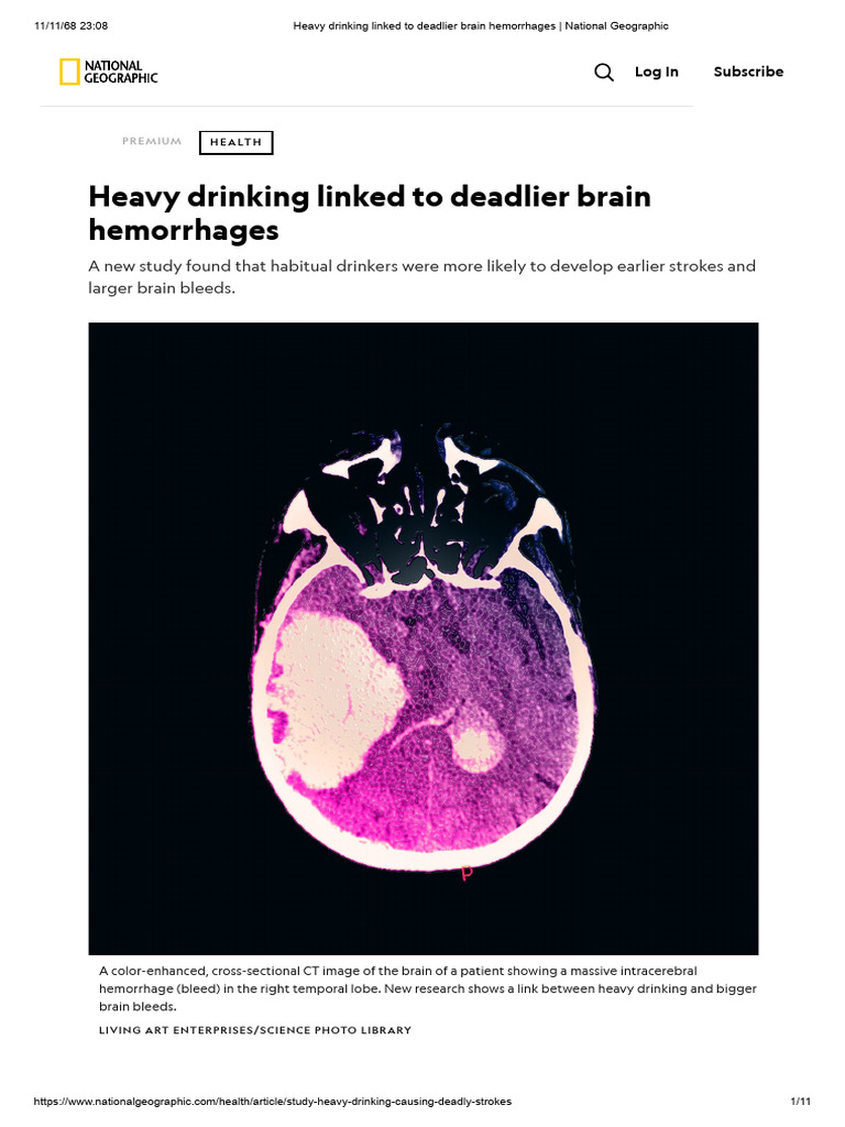 Heavy Drinking Linked To Deadlier Brain Hemorrhages - National ...