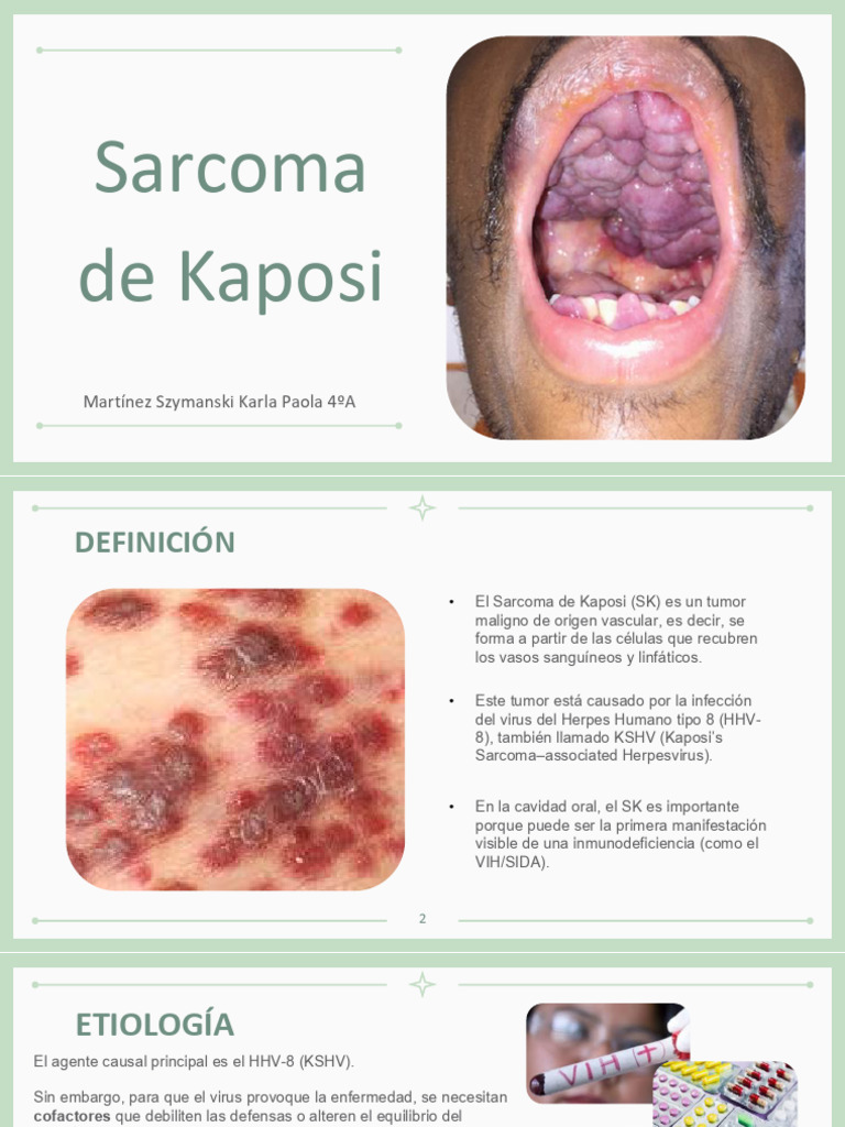 Sarcoma de Kaposi KPMS | PDF | VIH | Especialidades Medicas