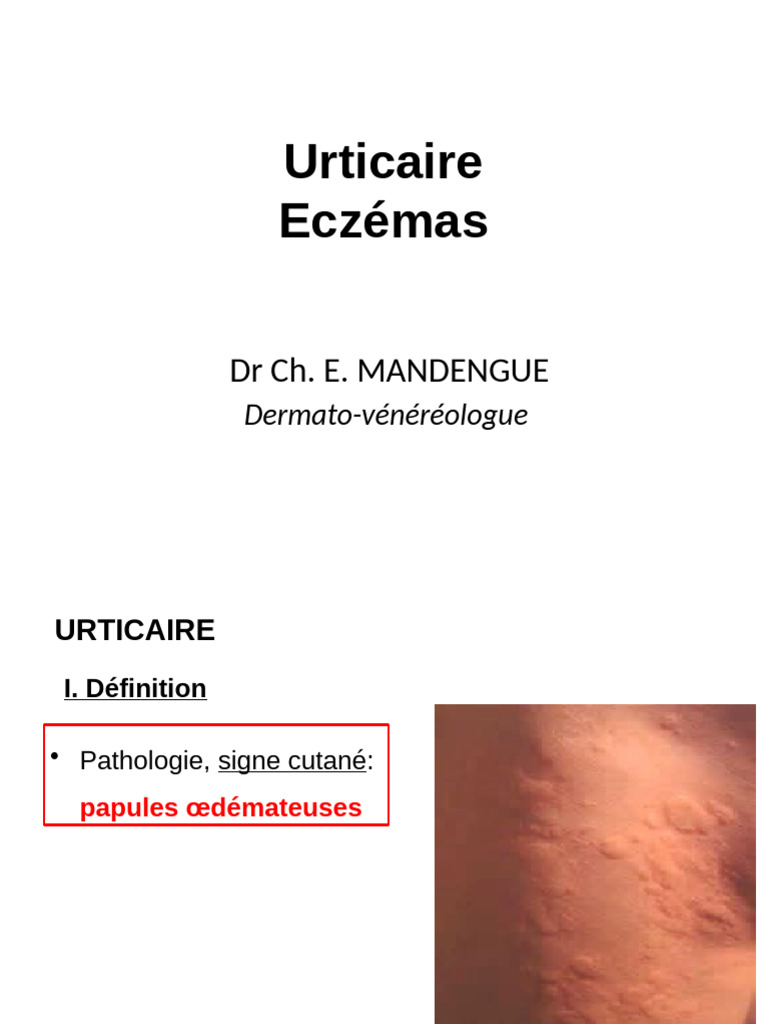 Urticaires et Eczémas : Diagnostic et Traitement | PDF | Dermatite ...