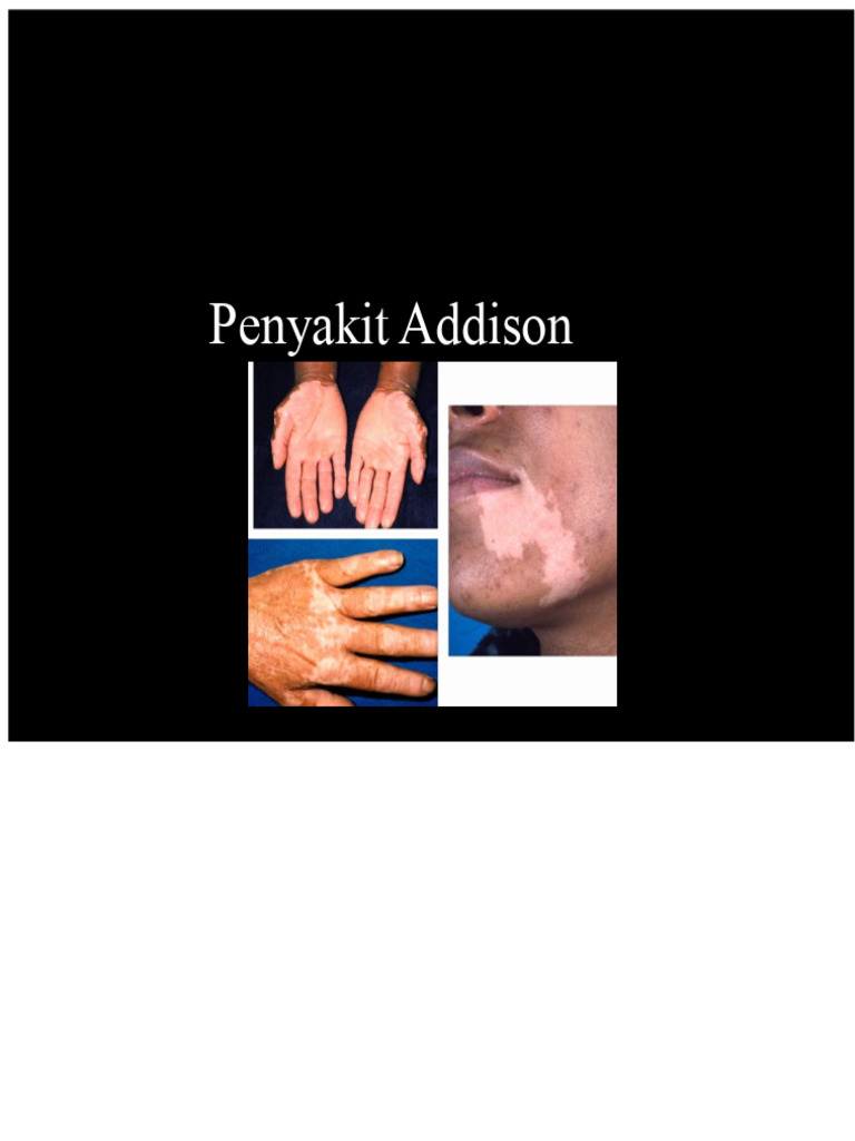 Penyakit Addison | PDF