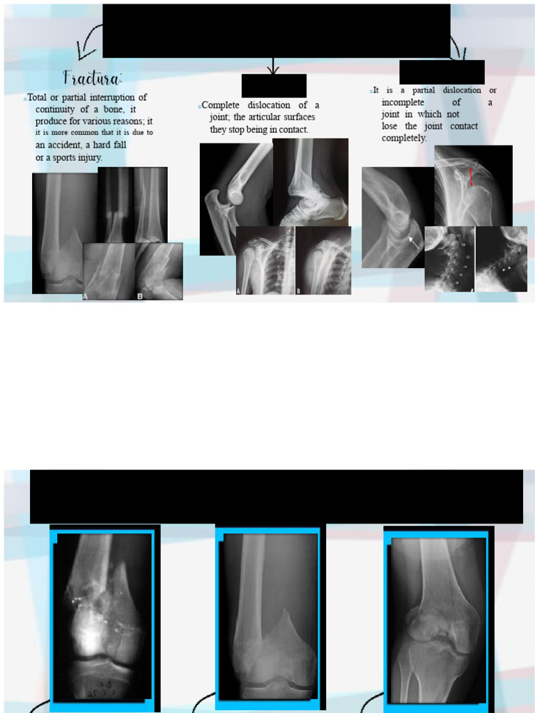 Types and Classifications of Bone Fractures | PDF | Musculoskeletal ...