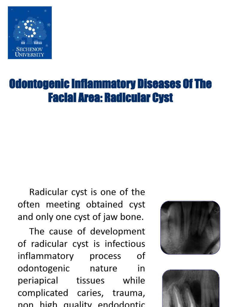 Radicular Cyst - Eng | PDF | Dentistry Branches | Medical Specialties
