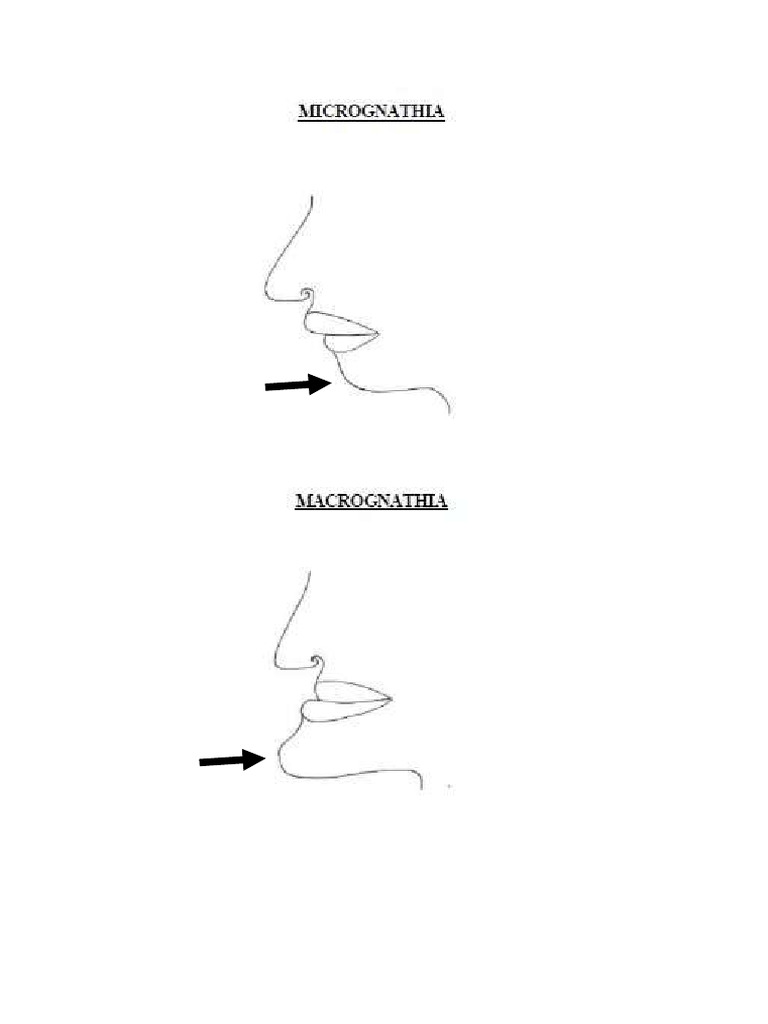 MACROGLOSSIA | PDF