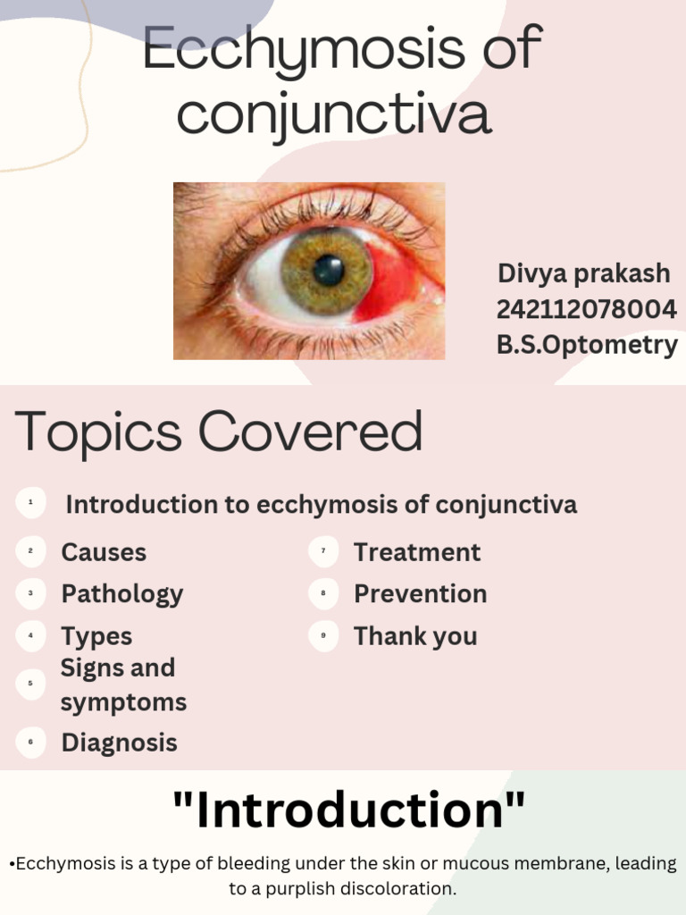 Understanding Conjunctival Ecchymosis | PDF | Bleeding | Human Diseases ...