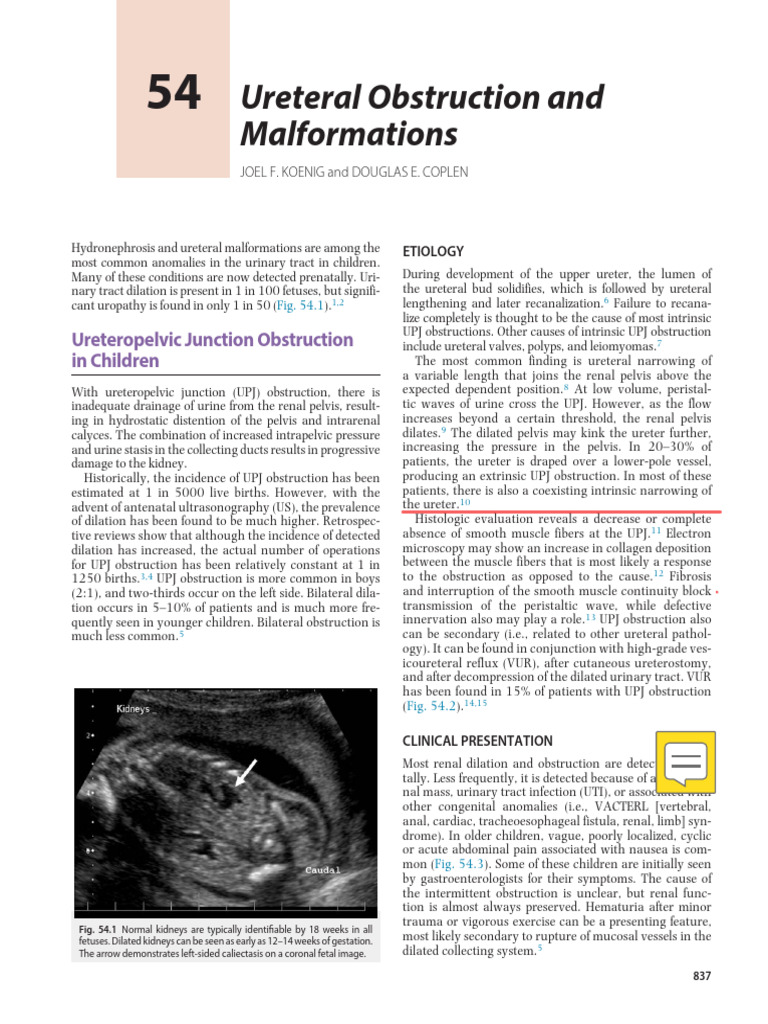 Ureteropelvic Junction Obstruction in Children | PDF | Kidney | Medical ...