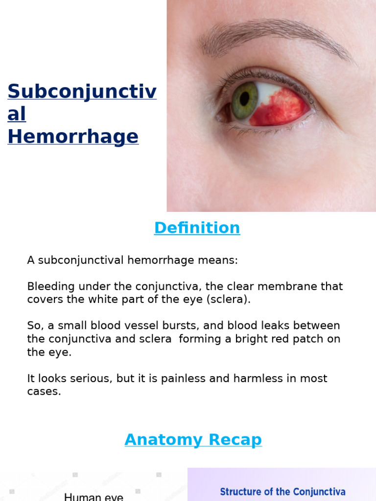 Subconjunctival Hemorrhage | PDF | Bleeding | Medical Specialties
