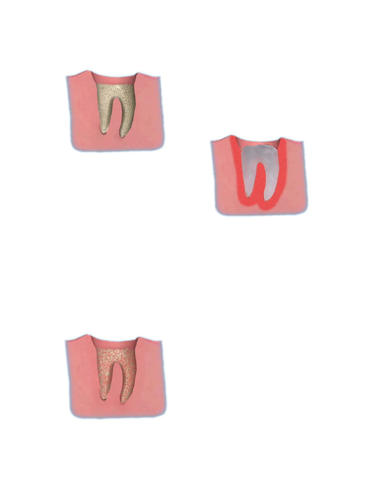 Dry Socket Infection | PDF