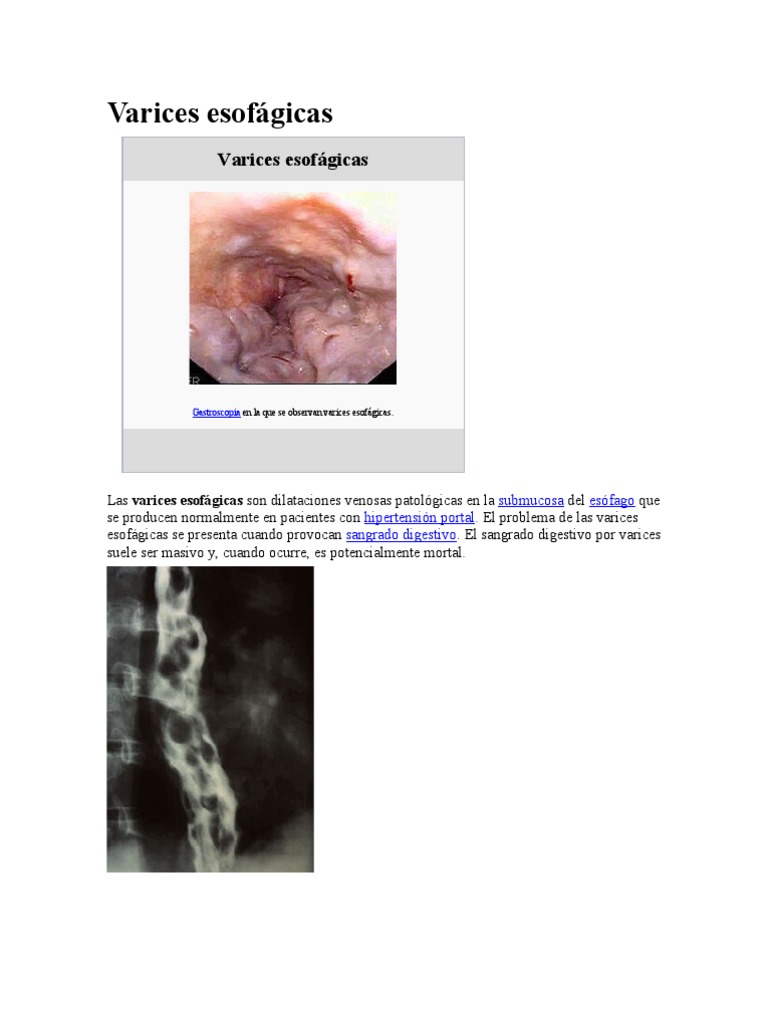 Varices Esofágicas | PDF | Cirrosis | Órgano (anatomía)