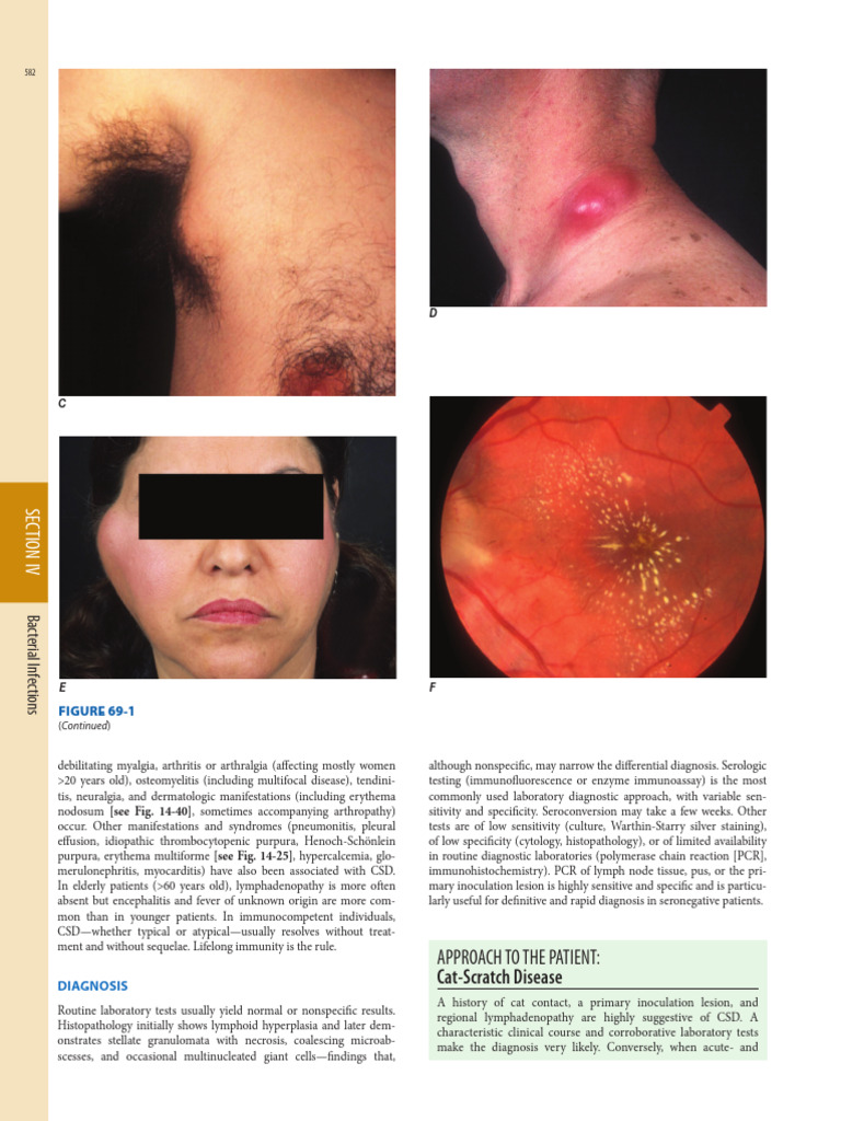 Cat-Scratch Disease Overview and Treatment | PDF | Microbiology ...