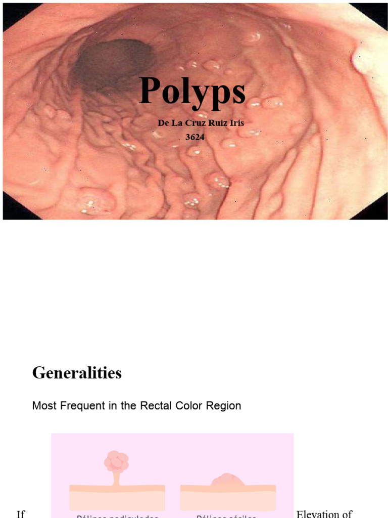 Polyps | PDF | Adenoma | Gastroenterology