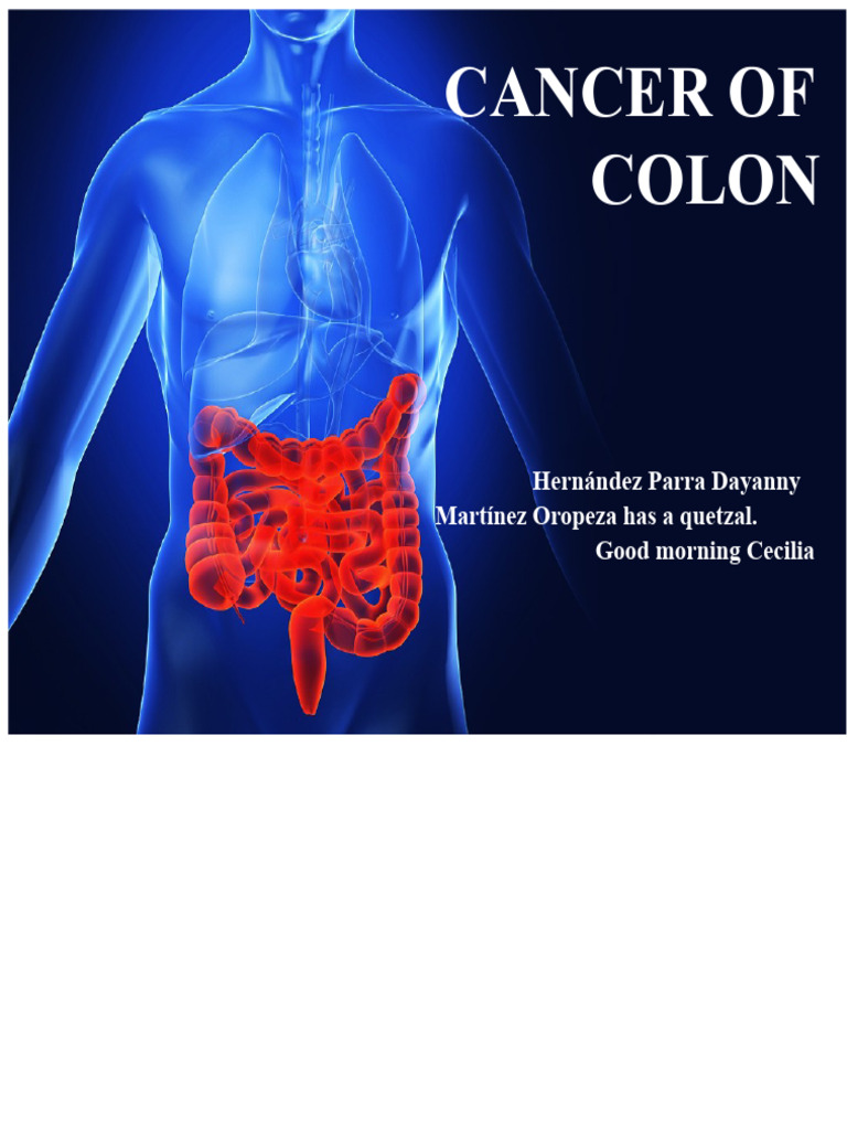 Understanding Colon Cancer: Causes & Prevention | PDF | Colorectal ...