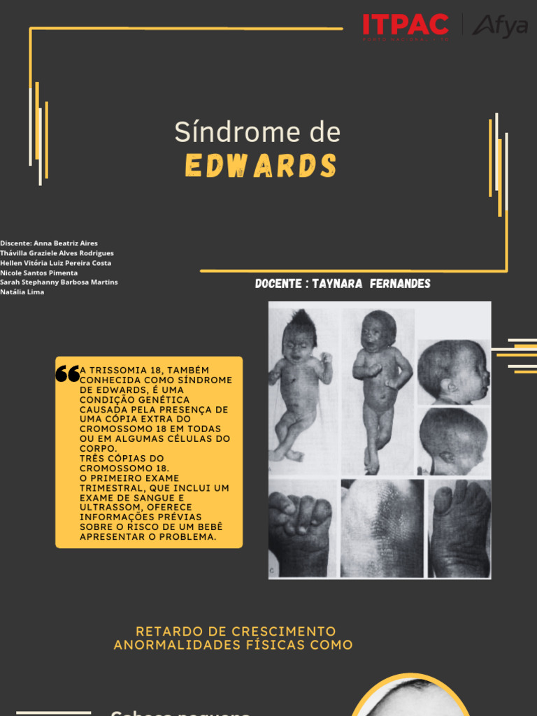 Síndrome de Edwards: Causas e Tratamento | PDF | Doenças e distúrbios ...