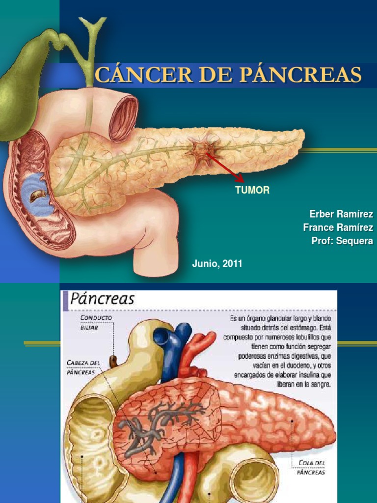 Cáncer de Páncreas: Patología y Diagnóstico | PDF | Páncreas | Cáncer ...