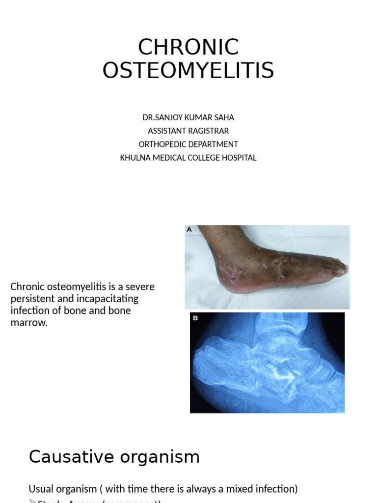 Chronic Osteomyelitis Overview and Treatment | PDF | Diseases And ...