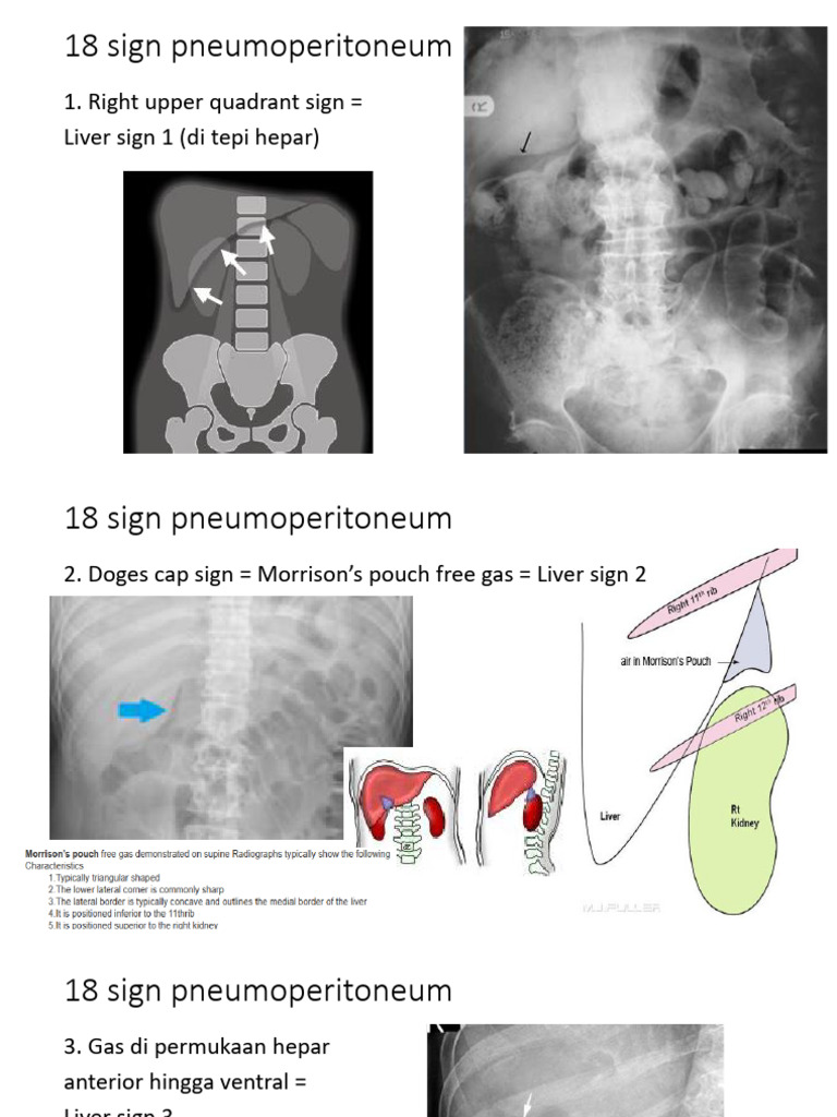 18 Sign Pneumoperitoneum | PDF