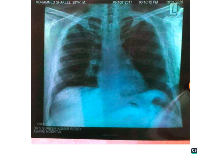 Chest Xray Report | PDF