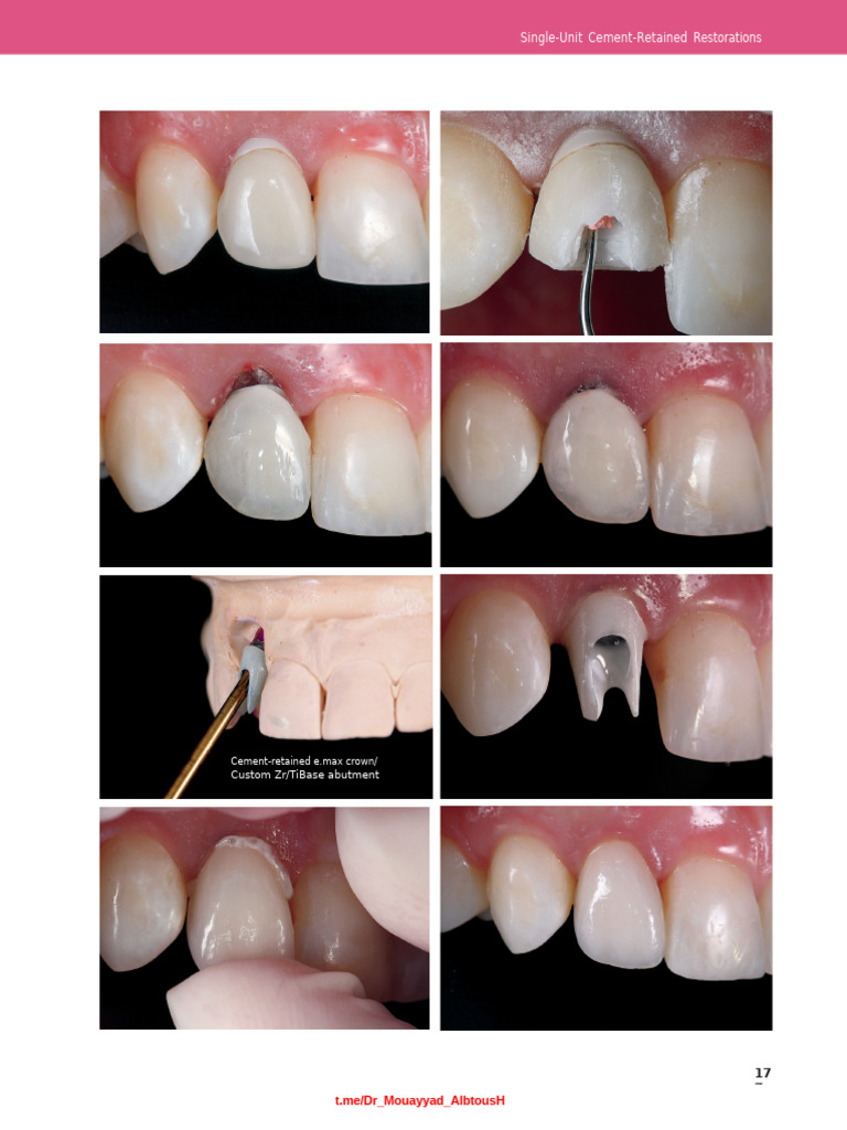 Single-Unit Cement-Retained Crowns | PDF