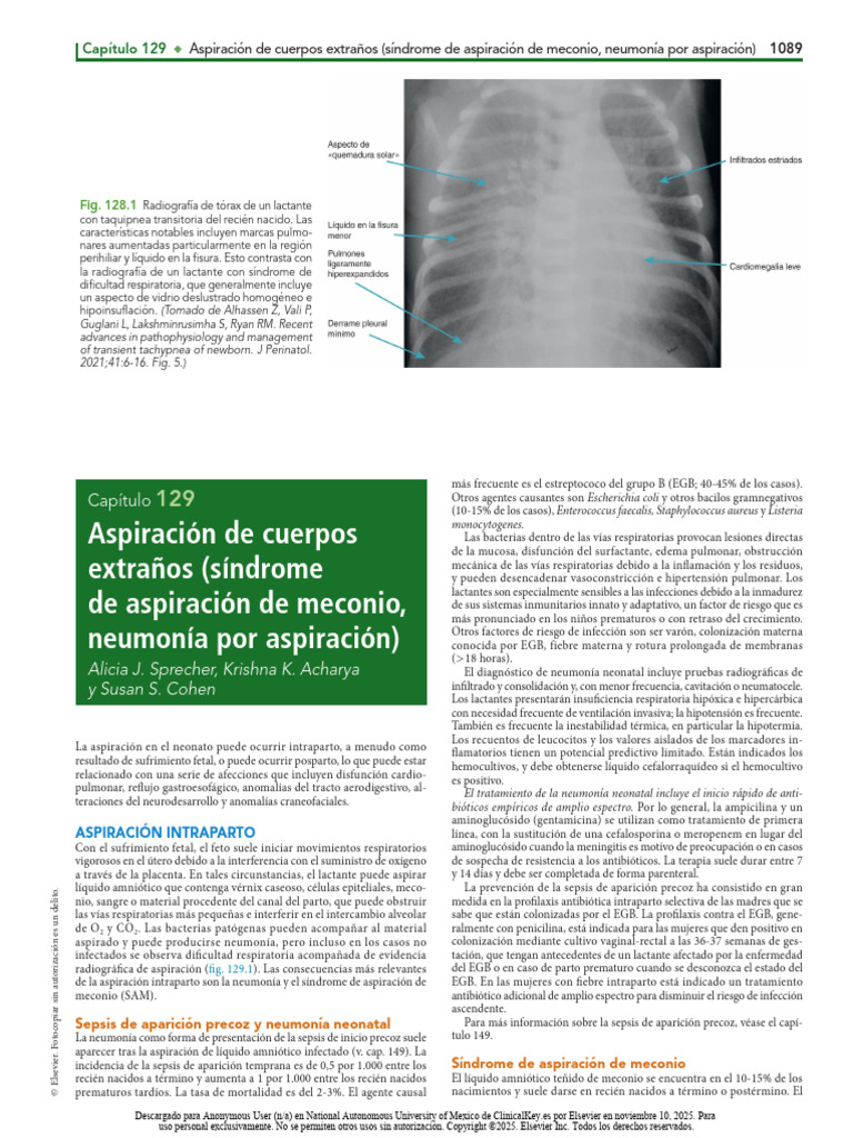 Sindrome de Aspiración de Meconio | PDF | Feto | Especialidades Medicas