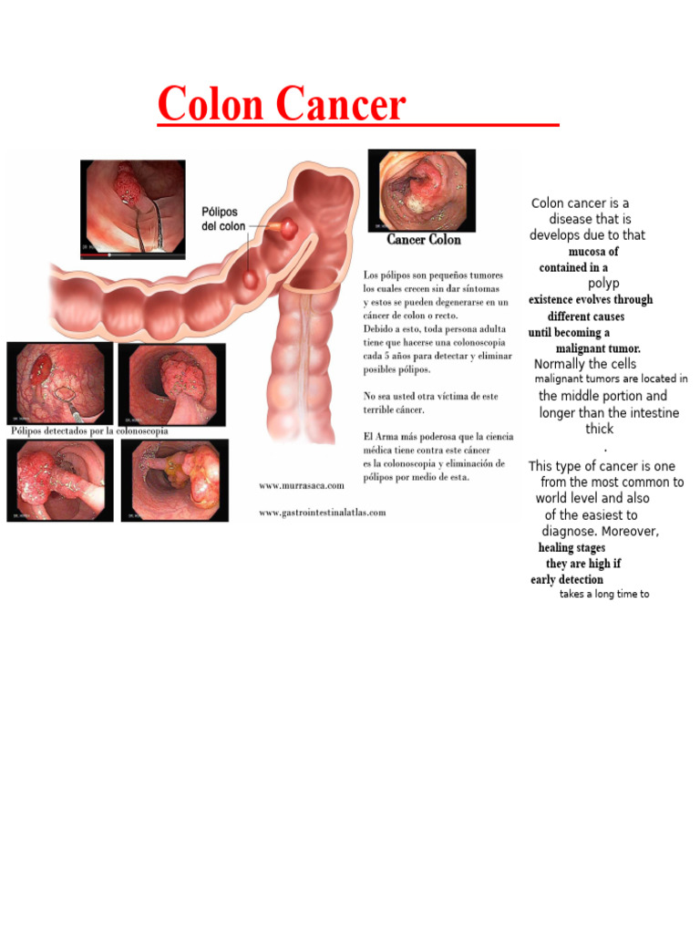 Colon Cancer | PDF | Colorectal Cancer | Cancer